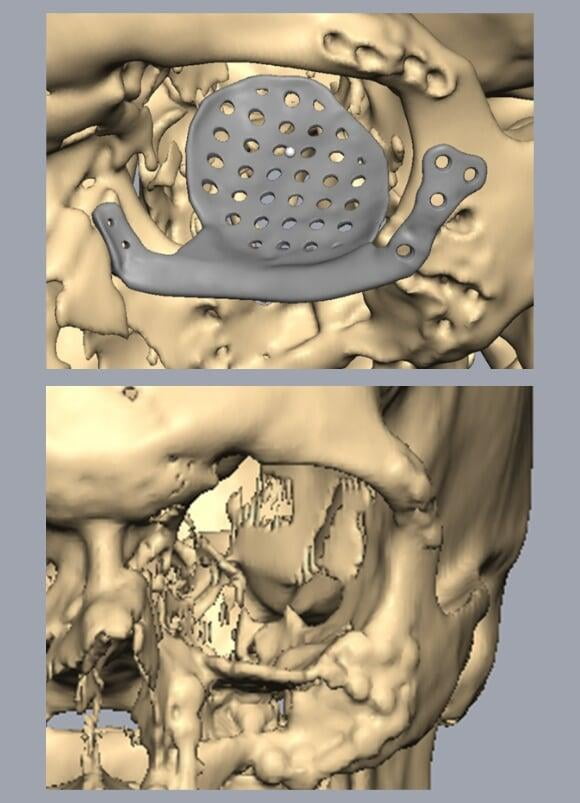 Maxillofacial | LUCID Implants | PSIs for CMF & Ortho